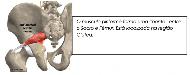 Entenda a Síndrome do Piriforme que pode ser confundida com Hérnia de ...